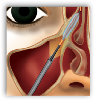 Sinus Endoscope FinESS™ From Entellus Medical Gets FDA Clearance For ...